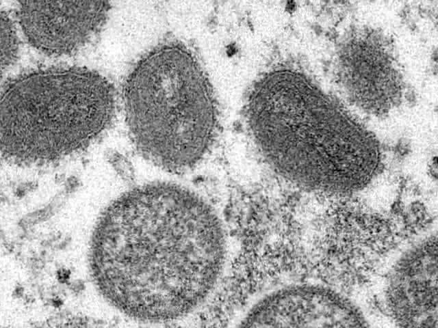 Iloilo logs first monkeypox case - Iloilo Metropolitan Times